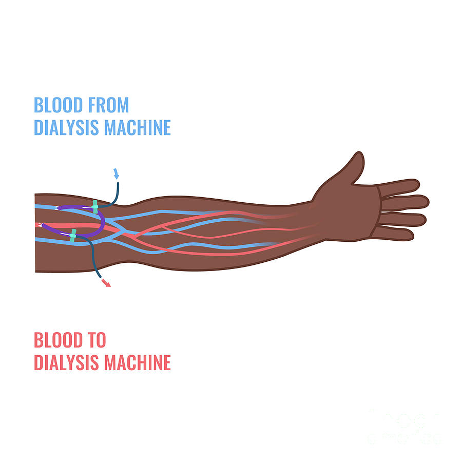 Dialysis Shunt Graft Catheter #3 by Art4Stock / Science Photo Library