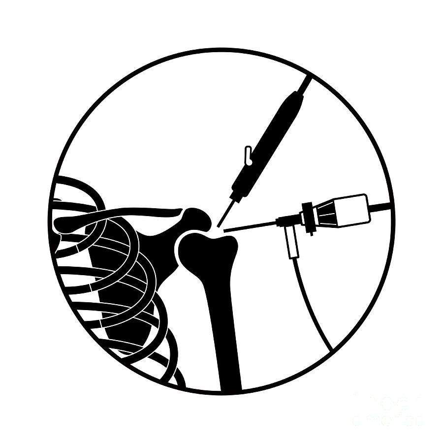 Shoulder Arthroscopy Procedure #3 by Pikovit / Science Photo Library