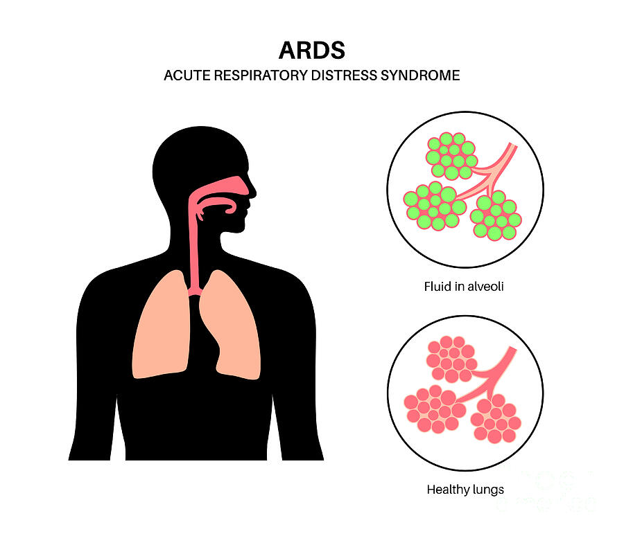 Acute Respiratory Distress #4 by Pikovit / Science Photo Library