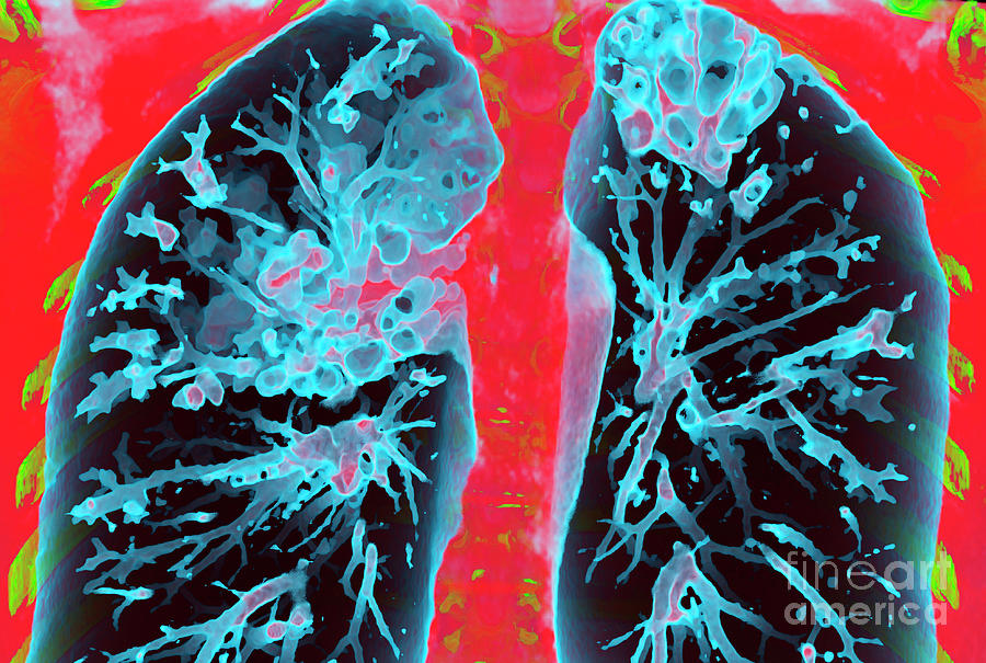 Bronchiectasis #5 by Vsevolod Zviryk / Science Photo Library