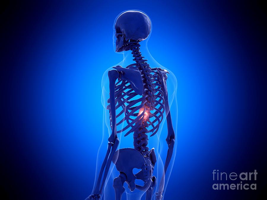 Painful Spine #5 by 3Dmedisphere / Science Photo Library