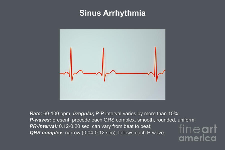 Sinus Arrhythmia Heartbeat Rhythm #6 by Kateryna Kon / Science Photo ...