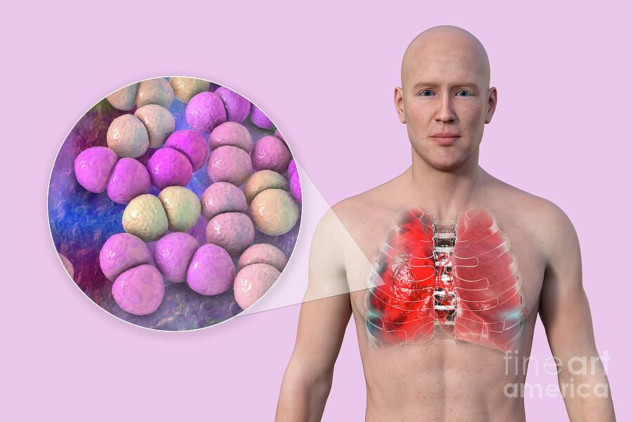 Lungs Affected By Pneumonia #7 by Kateryna Kon / Science Photo Library