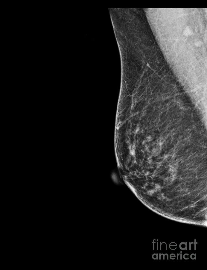 Normal Mammogram #7 by Samunella / Science Photo Library
