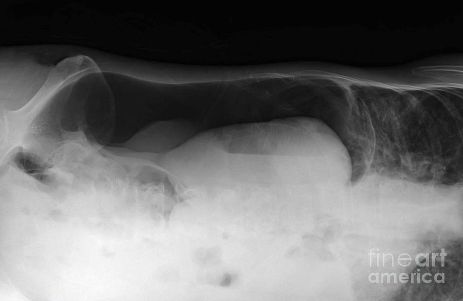 Pneumoperitoneum #7 by Rajaaisya / Science Photo Library