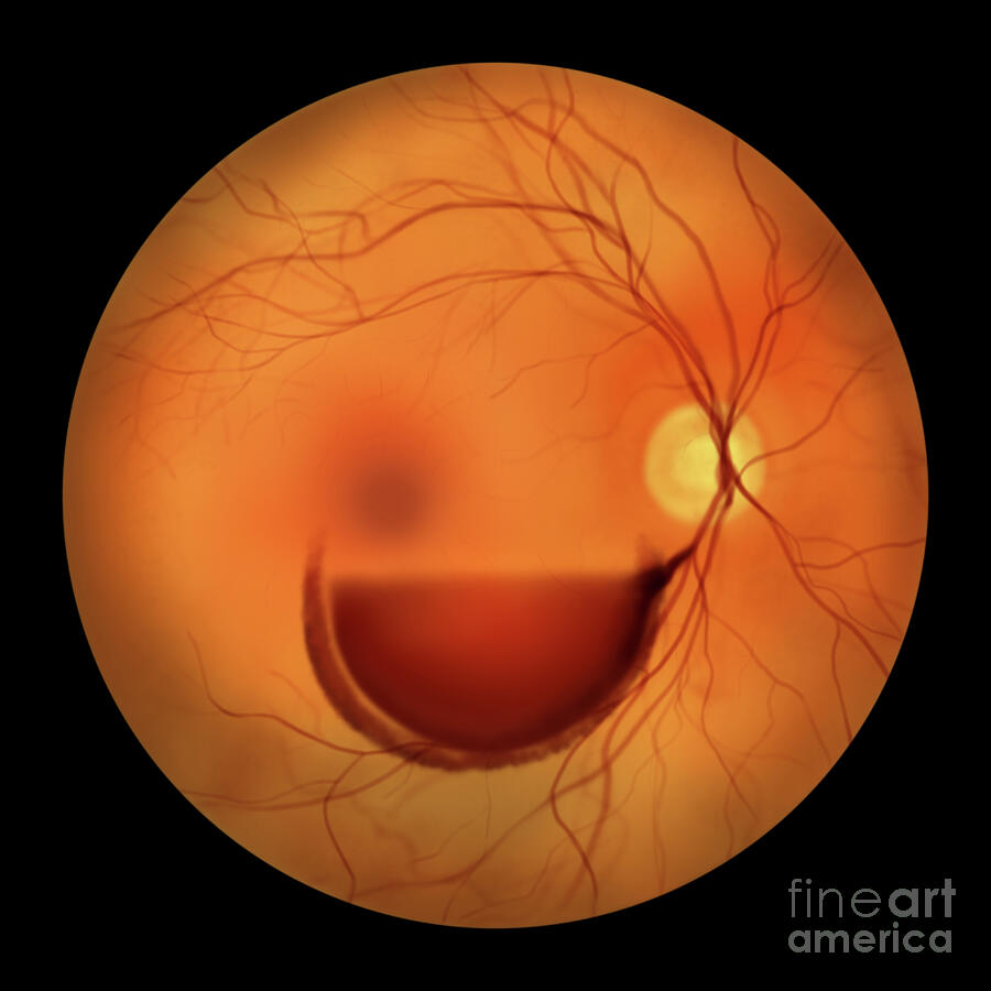 Valsava Retinopathy #7 by Kateryna Kon / Science Photo Library