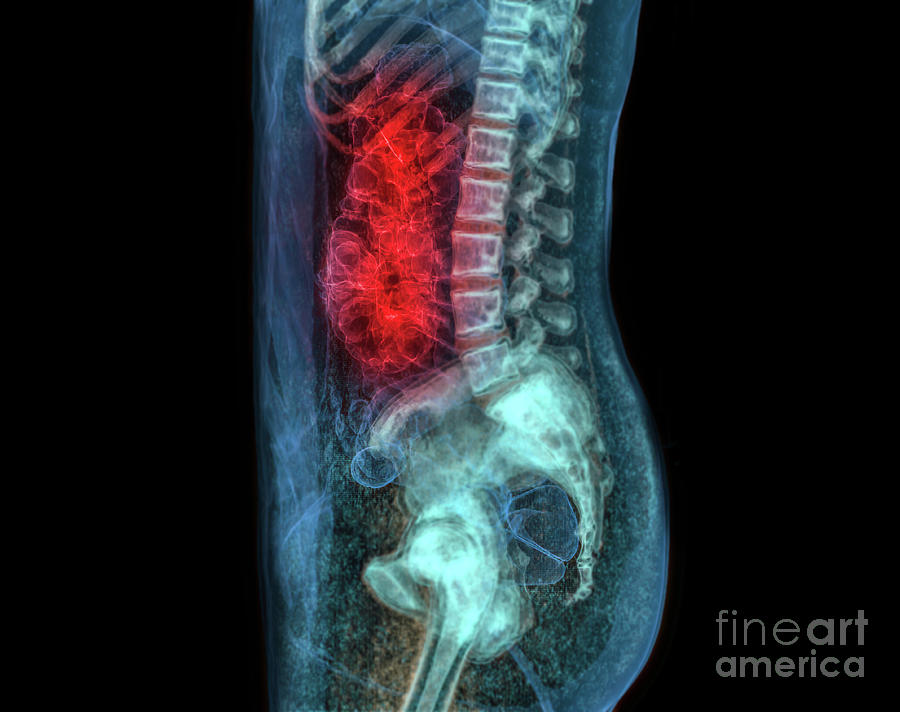 Abdominal Pain by Samunella / Science Photo Library