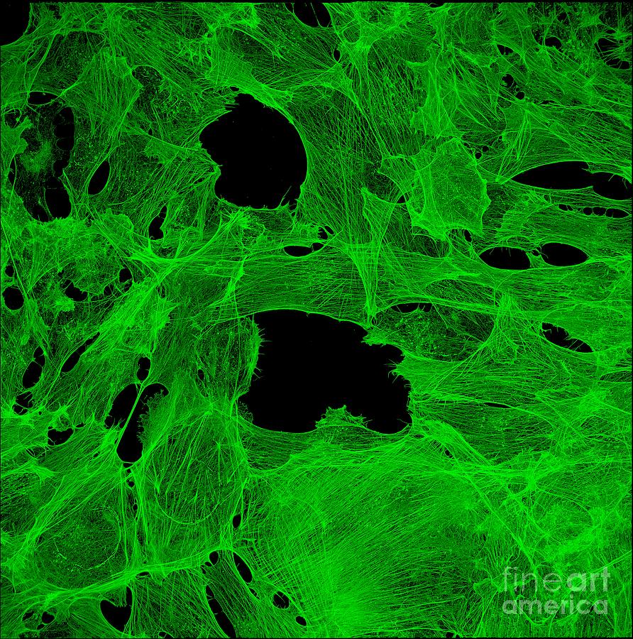 Cancer Cells Showing Cytoskeleton by "Howard Vindin, The University Of ...
