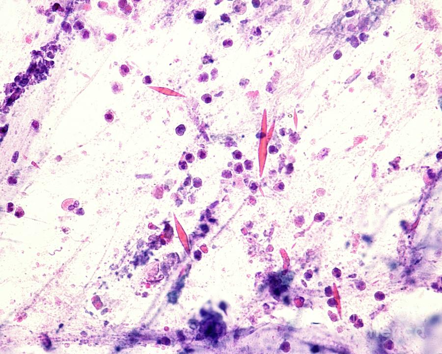 Charcot-leyden Crystals In Sputum Smear by Jose Calvo / Science Photo ...