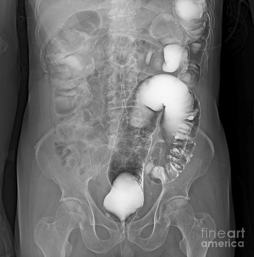 Colon Diverticula by Rajaaisya / Science Photo Library