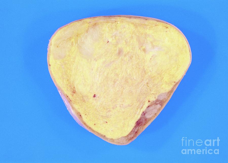 Cut Specimen Of Thecoma (theca Cell Tumour) by Dr. E. Walker / Science ...