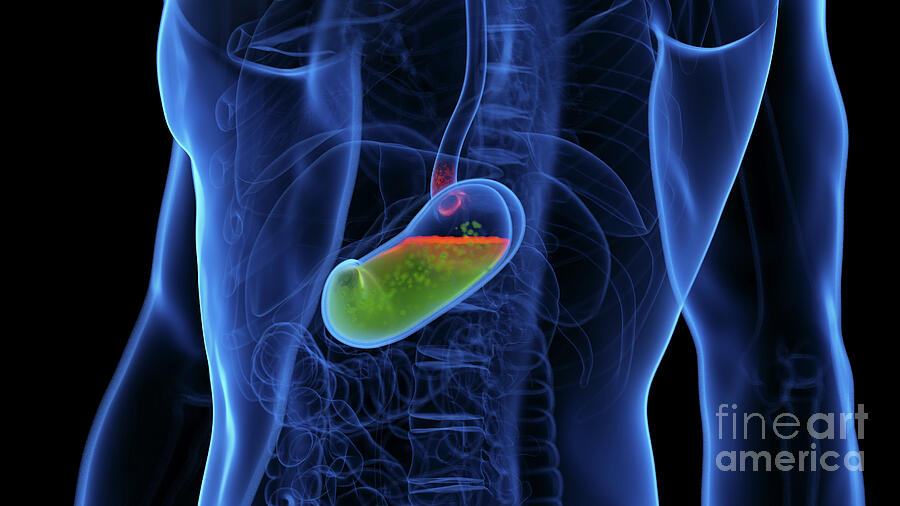Gastroesophageal Reflux Disease by 3Dmedisphere / Science Photo Library