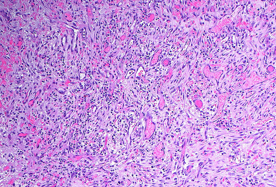 Granulation Tissue by Ziad M. El-Zaatari / Science Photo Library