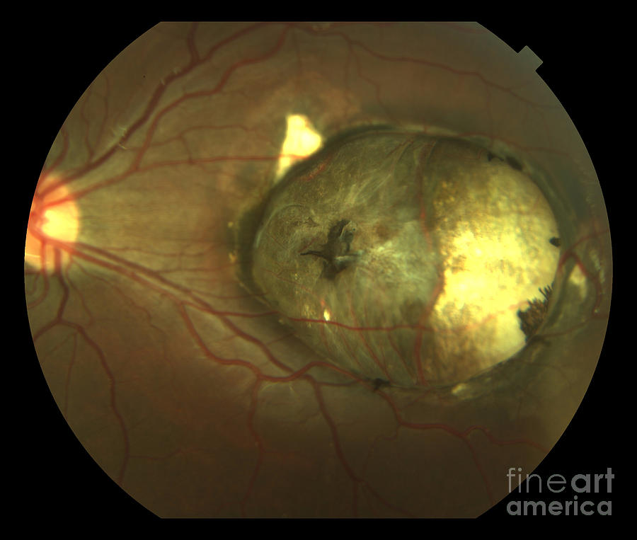 Macular Coloboma by Alan Frohlichstein / Science Photo Library