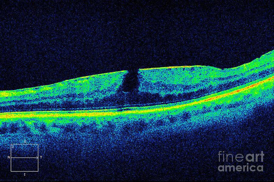 Macular Pucker With Lamellar Hole by Alan Frohlichstein / Science Photo ...