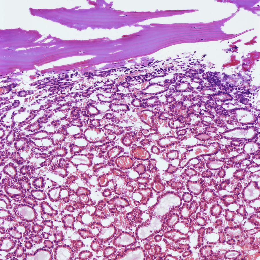 Metastatic Bone Cancer by Steve Gschmeissner / Science Photo Library