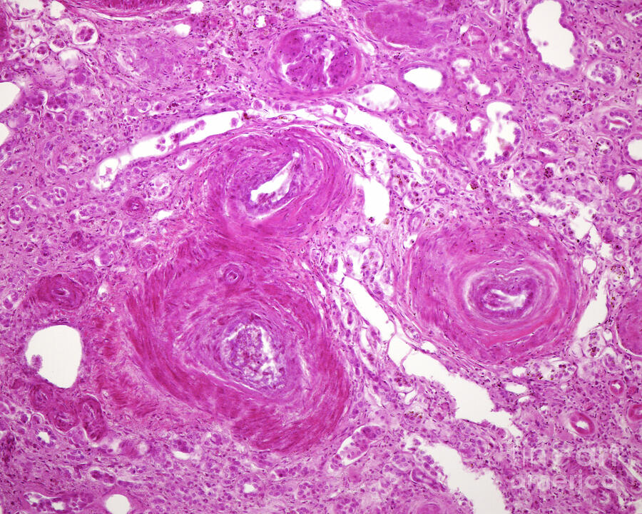 Nephrosclerosis In Human Kidney by Jose Calvo / Science Photo Library