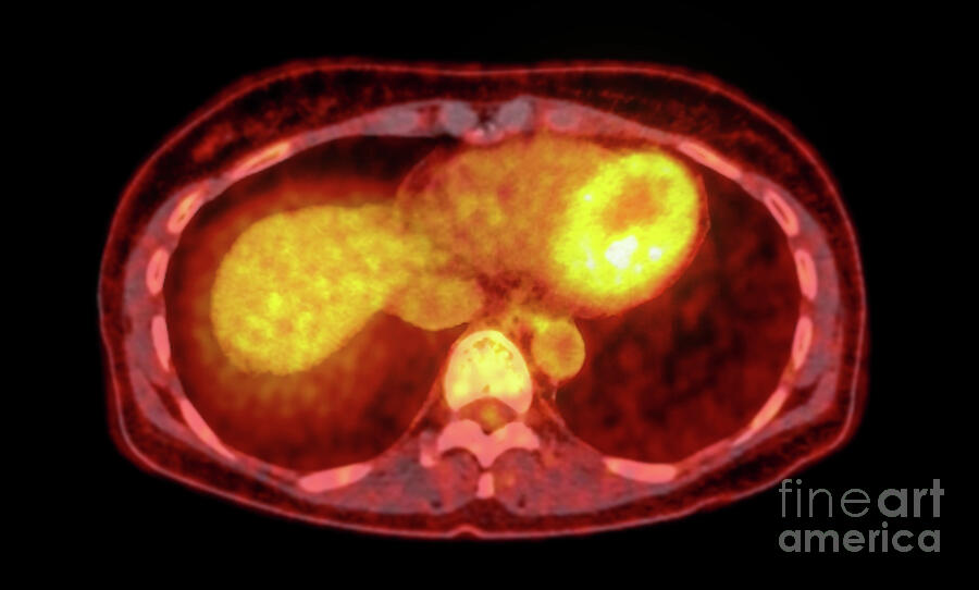 Normal Abdomen by Samunella / Science Photo Library