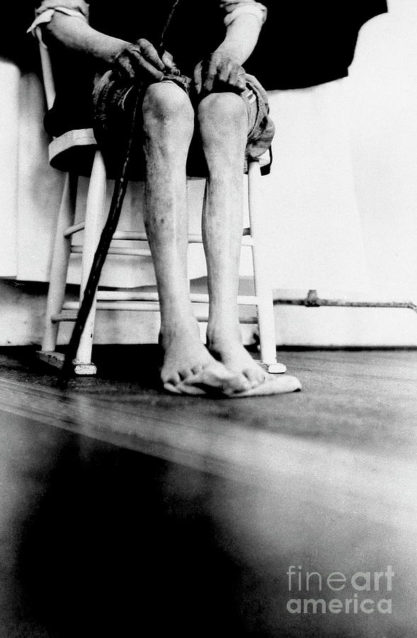 Plague Victim by Usa National Library Of Medicine / Science Photo Library