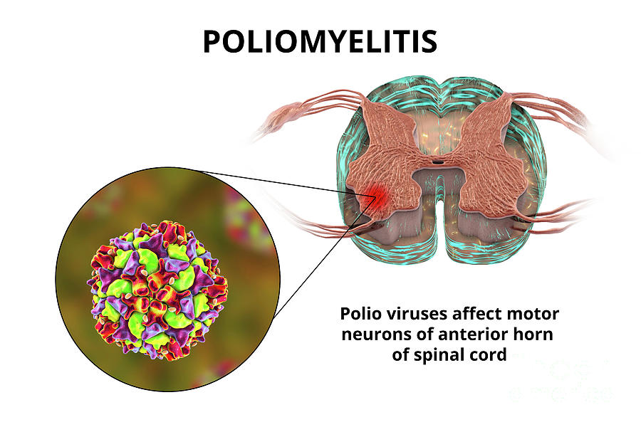 Polio Viruses Affecting Motor Neurons by Kateryna Kon / Science Photo ...