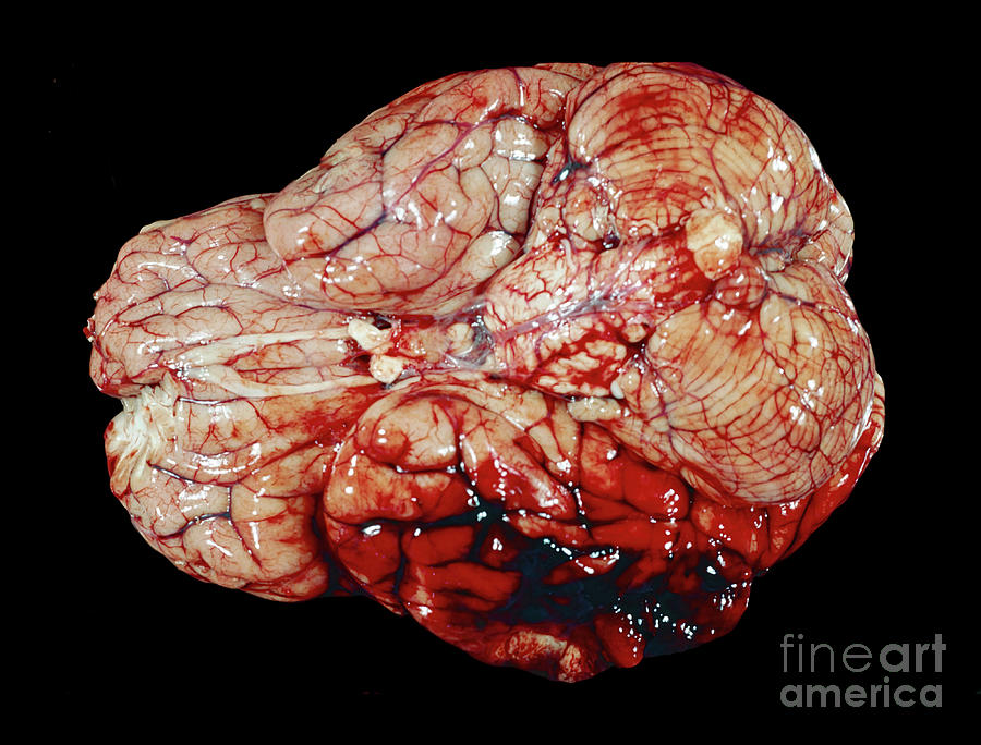 Temporal Lobe Stroke by Jose Calvo / Science Photo Library