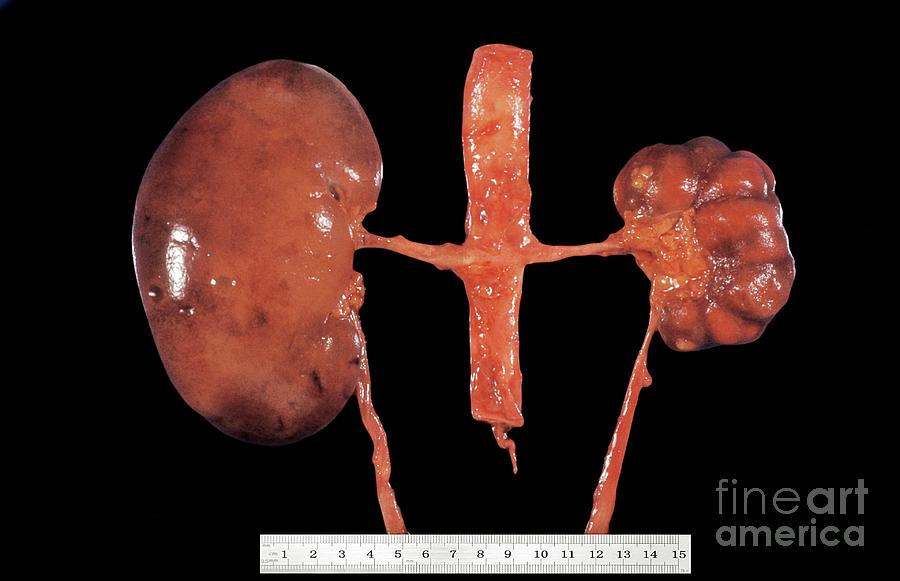 Unilateral Atrophy Of Kidney by Jose Calvo / Science Photo Library